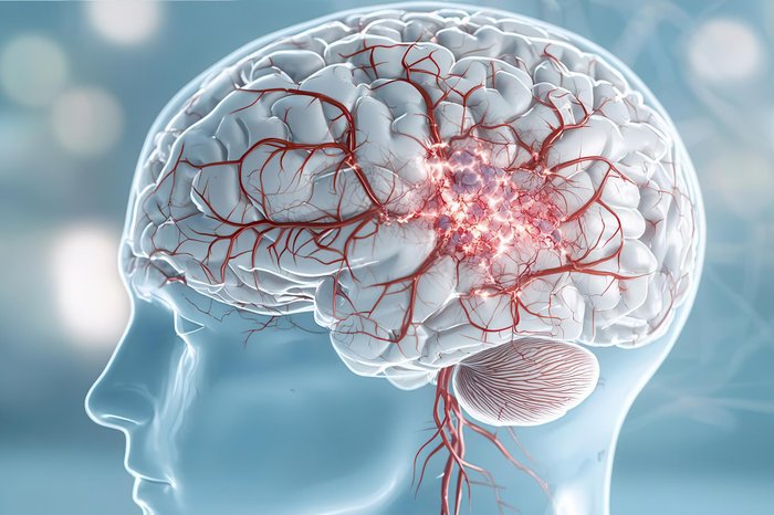O Que A Hemorragia Cerebral Diagnstico E Como Tratar Liga Paraibana De