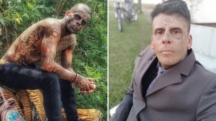 Mais tatuado do Brasil passa por nova sessão de remoção e mostra antes ...