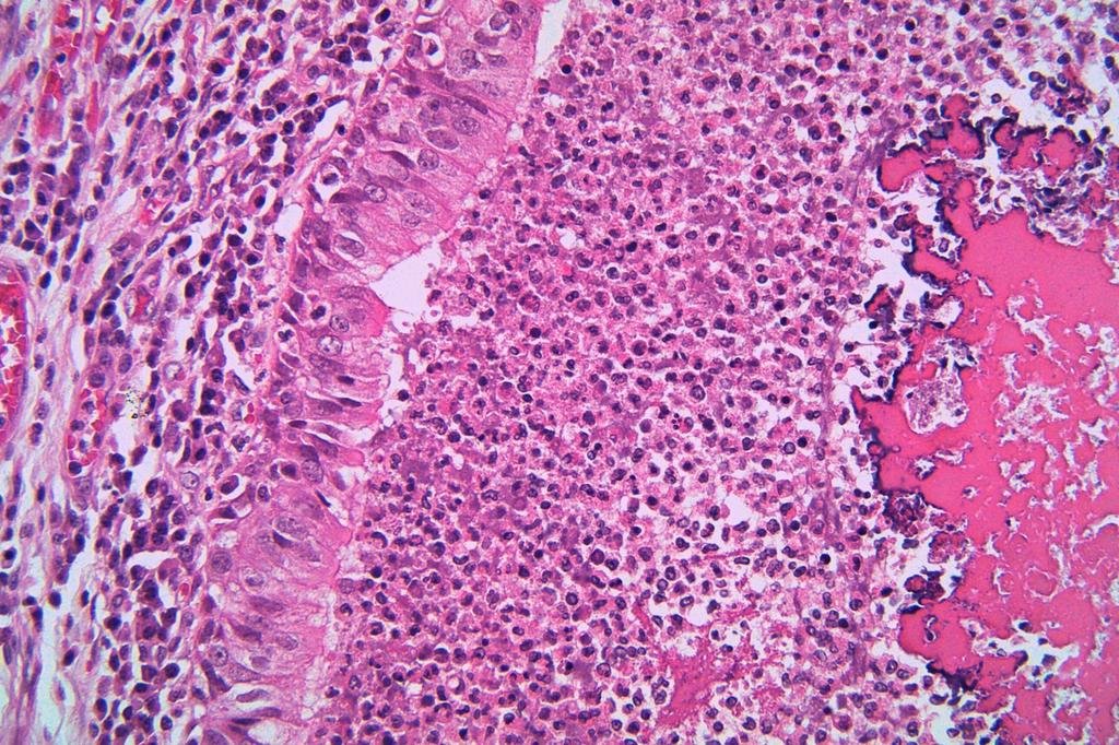 Entenda a fibrose cística, doença genética que afeta mais de 6 mil ...
