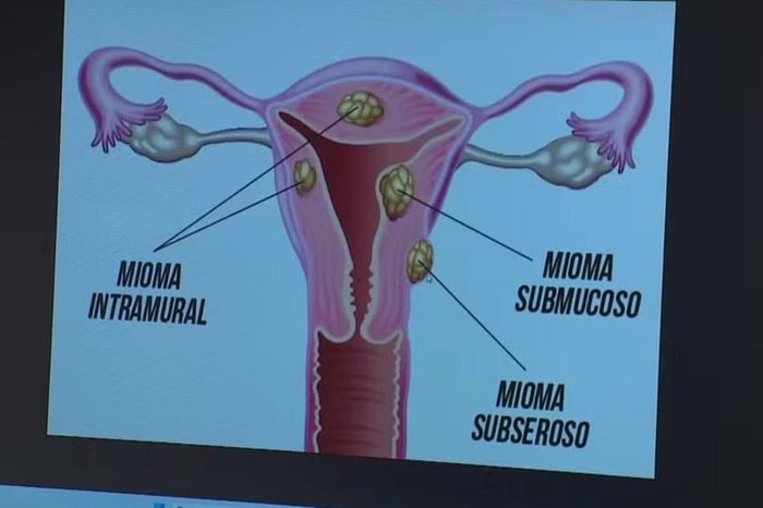 Hospital de Porto Alegre testará tratamento contra mioma que provoca ...