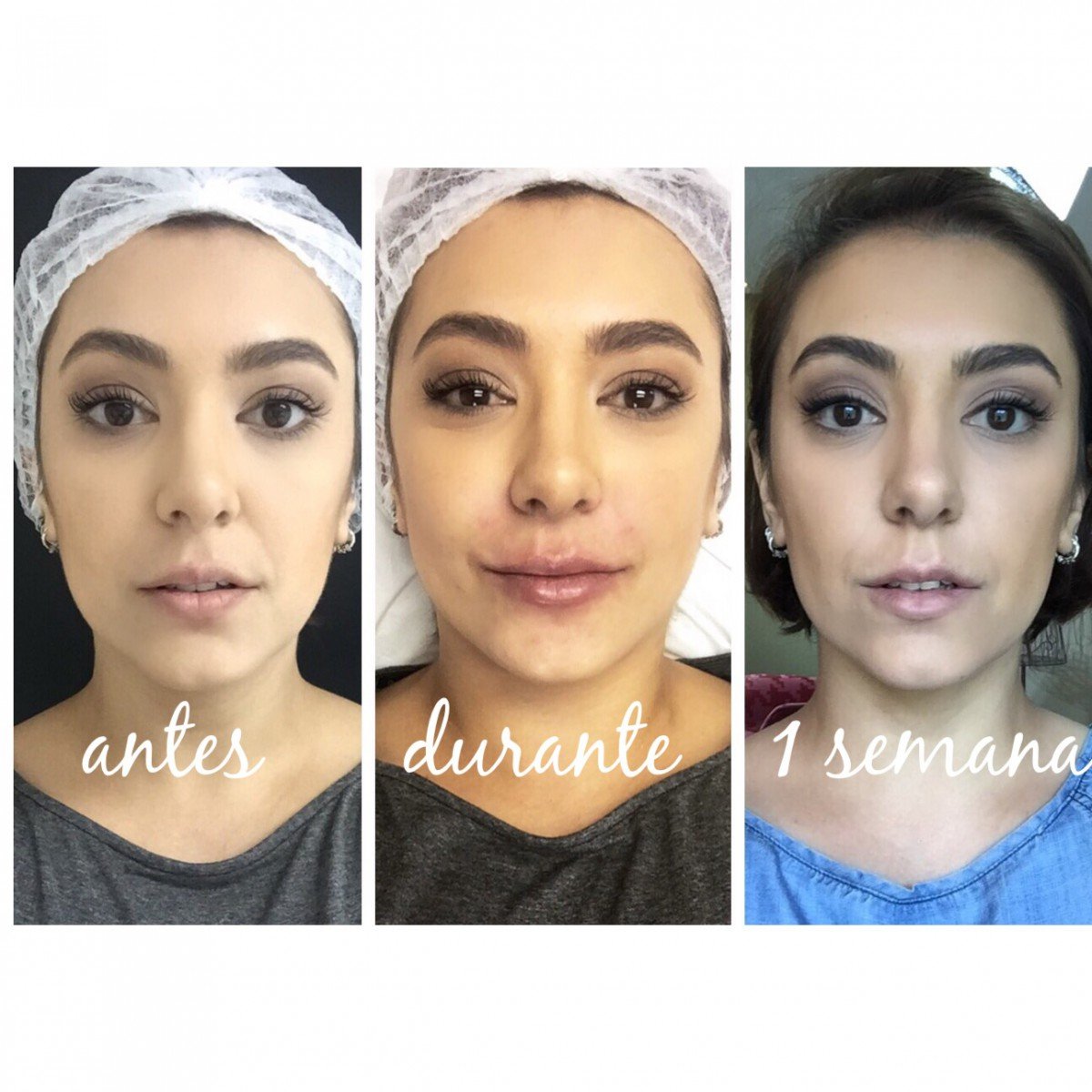 Preenchimento labial: confira o antes e depois da nossa colunista de ...